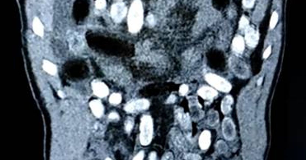 Bodypacker transportierte mehr als zwei Kilo Kokain und Heroin ...